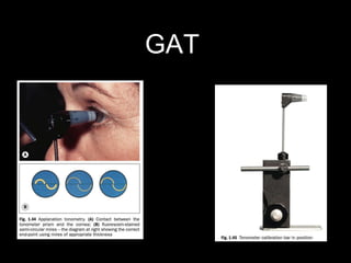 INTRAOCULAR PRESSURE &TONOMETRY Dr. ZAW MIN HTET (OPHTHALMOLOGIST) | PPT