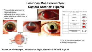 TRAUMA OCULAR CERRADO. | PPTX