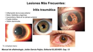 TRAUMA OCULAR CERRADO. | PPTX