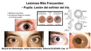 TRAUMA OCULAR CERRADO. | PPTX