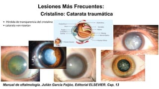 TRAUMA OCULAR CERRADO. | PPTX