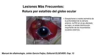 TRAUMA OCULAR CERRADO. | PPTX