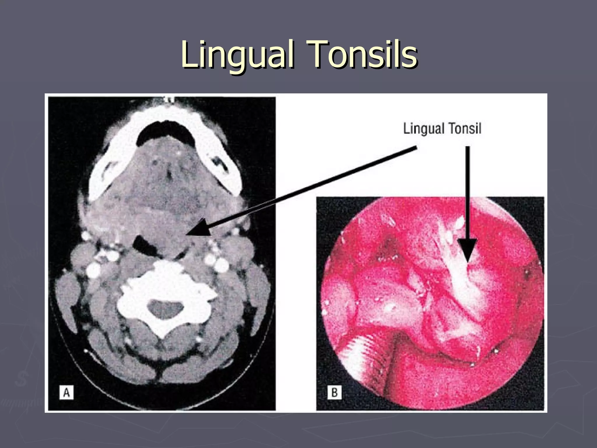 Special situations in tonsil and Adenoid disorder Special situations in tonsil and Adenoid ...