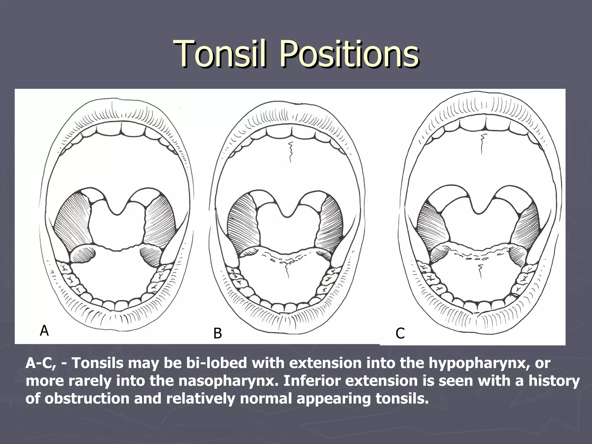 Special situations in tonsil and Adenoid disorder Special situations in ...