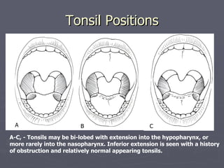 Special situations in tonsil and Adenoid disorder Special situations in ...