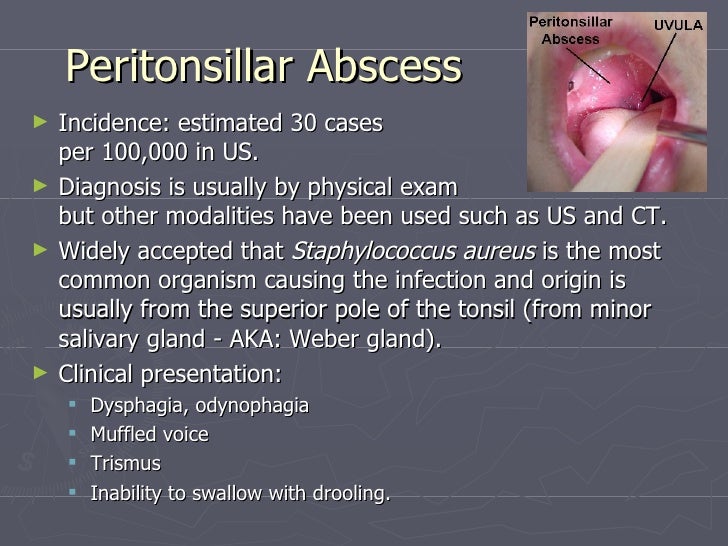 Tonsillitis Early Stages