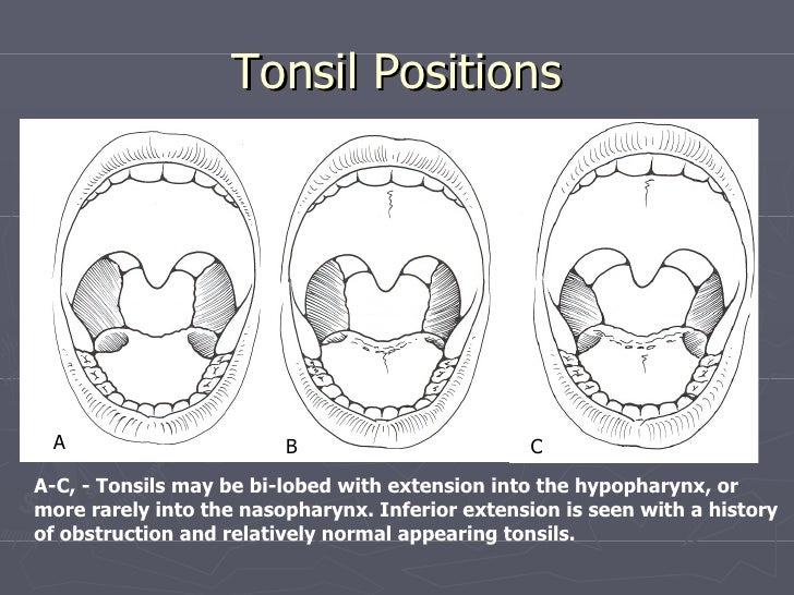 Tonsil Grading Chart