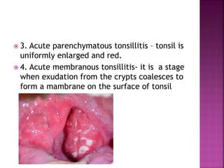 Tonsil anatomy and acute tonsil | PPTX
