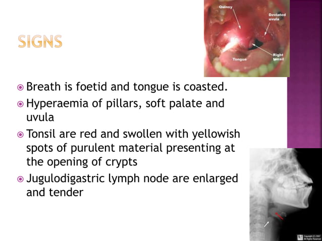 Tonsil anatomy and acute tonsil | PPTX