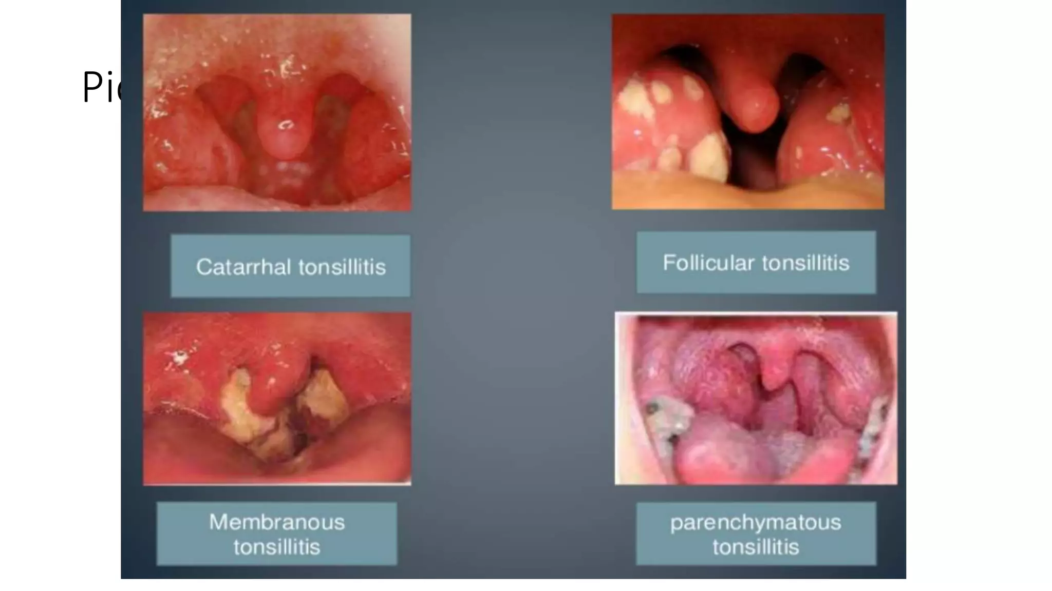 Tonsilar disease | PPTX