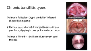 Tonsilar disease | PPTX