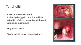Tonsilar disease | PPTX