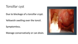 Tonsilar disease | PPTX
