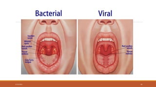 Tonsillar diseases and tonsillectomy .pptx