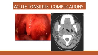 Tonsillar diseases and tonsillectomy .pptx