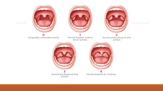 Tonsillar diseases and tonsillectomy .pptx
