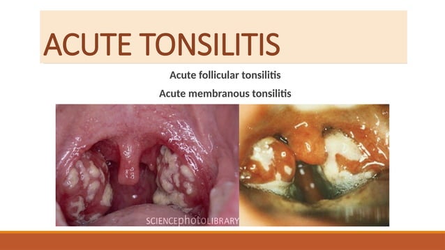 Tonsillar diseases and tonsillectomy .pptx