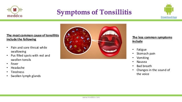 Tonsillitis types,Causes,Symptoms,Diagnosis,Prevention and treatment