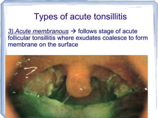 Tonsil fior UG.ppt
