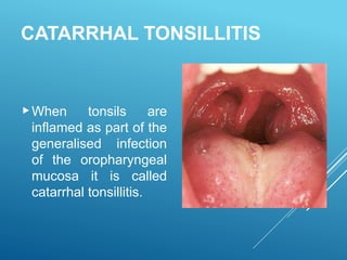tonsilillitis and its nursing management .pptx