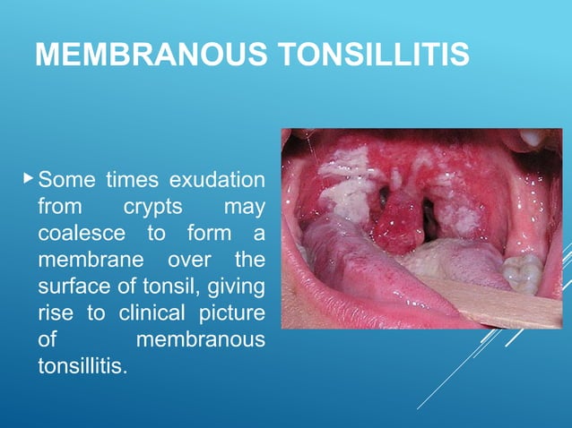 tonsilillitis and its nursing management .pptx | Ear, Nose and Throat ...