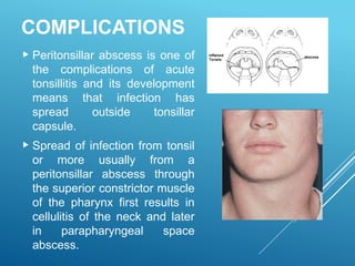 tonsilillitis and its nursing management .pptx