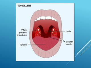 tonsilillitis and its nursing management .pptx