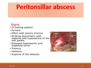 Tonsillar diseases and Tonsillectomy. power point presentation | PPTX