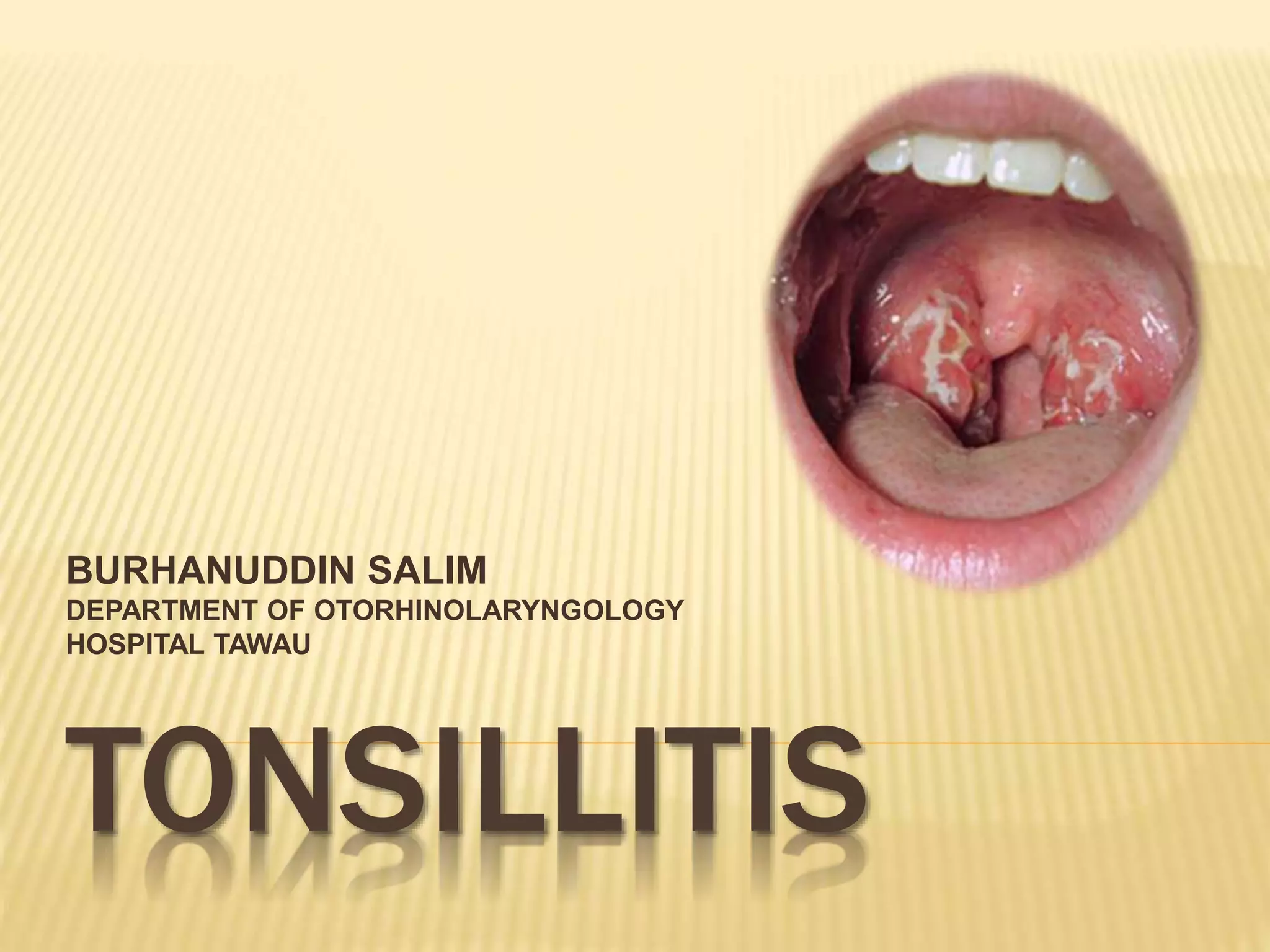 Tonsilitis | PPTX