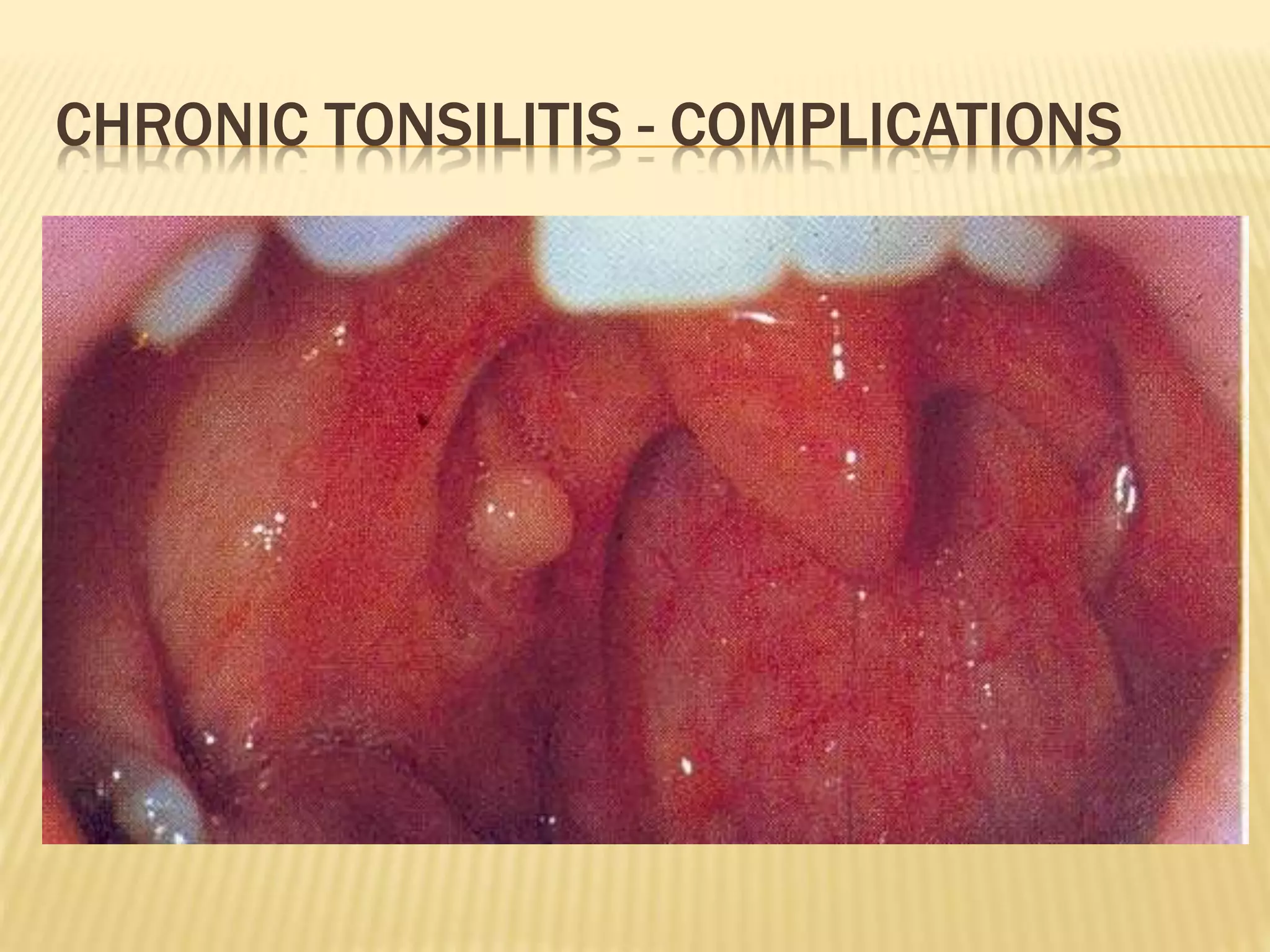 Tonsilitis | PPTX