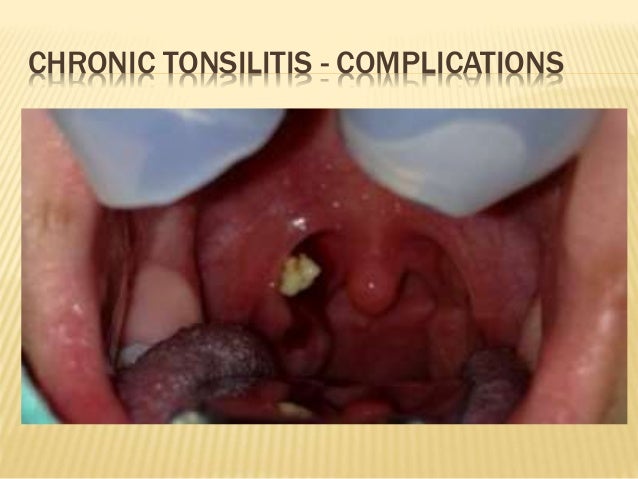 Tonsilitis