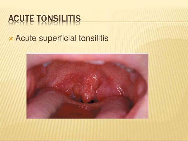 Tonsilitis