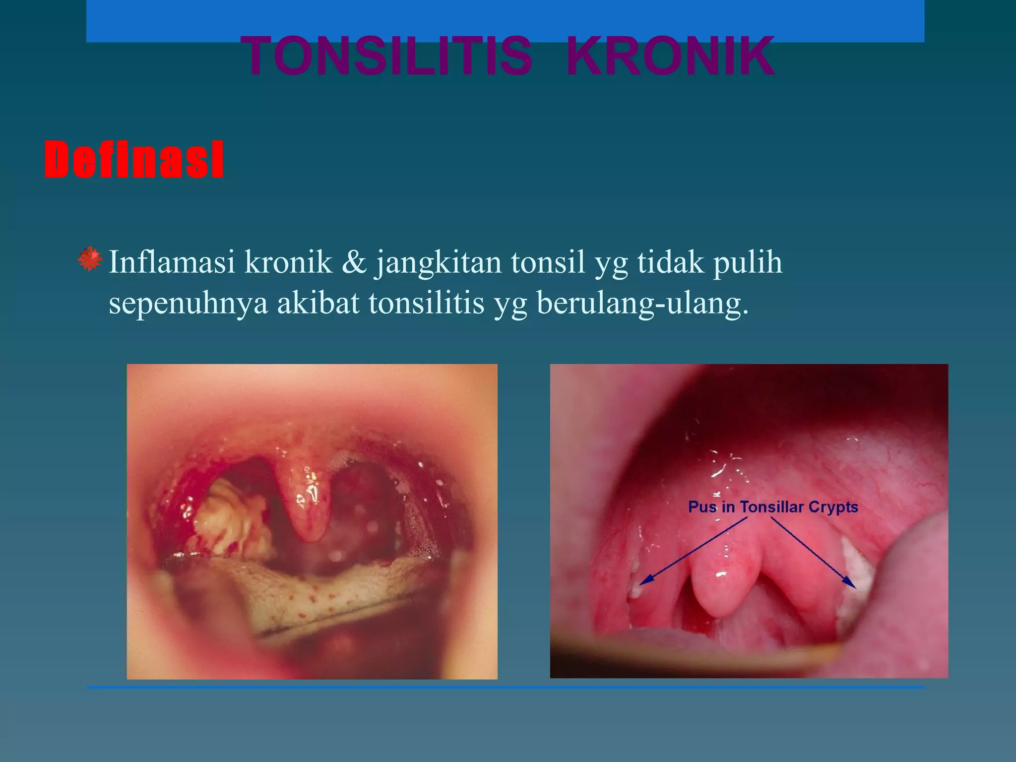 TONSILITIS | PPT