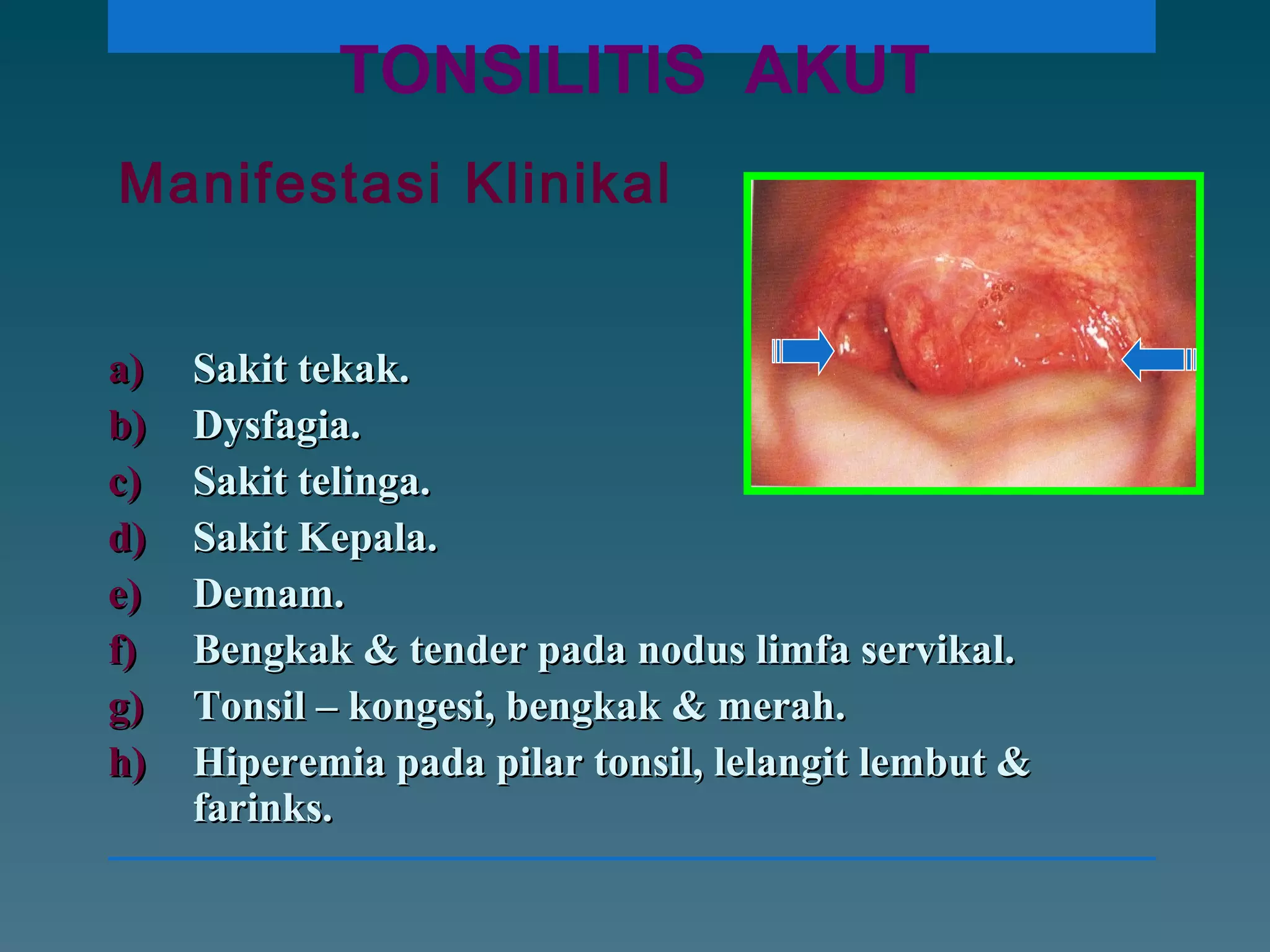 TONSILITIS | PPT