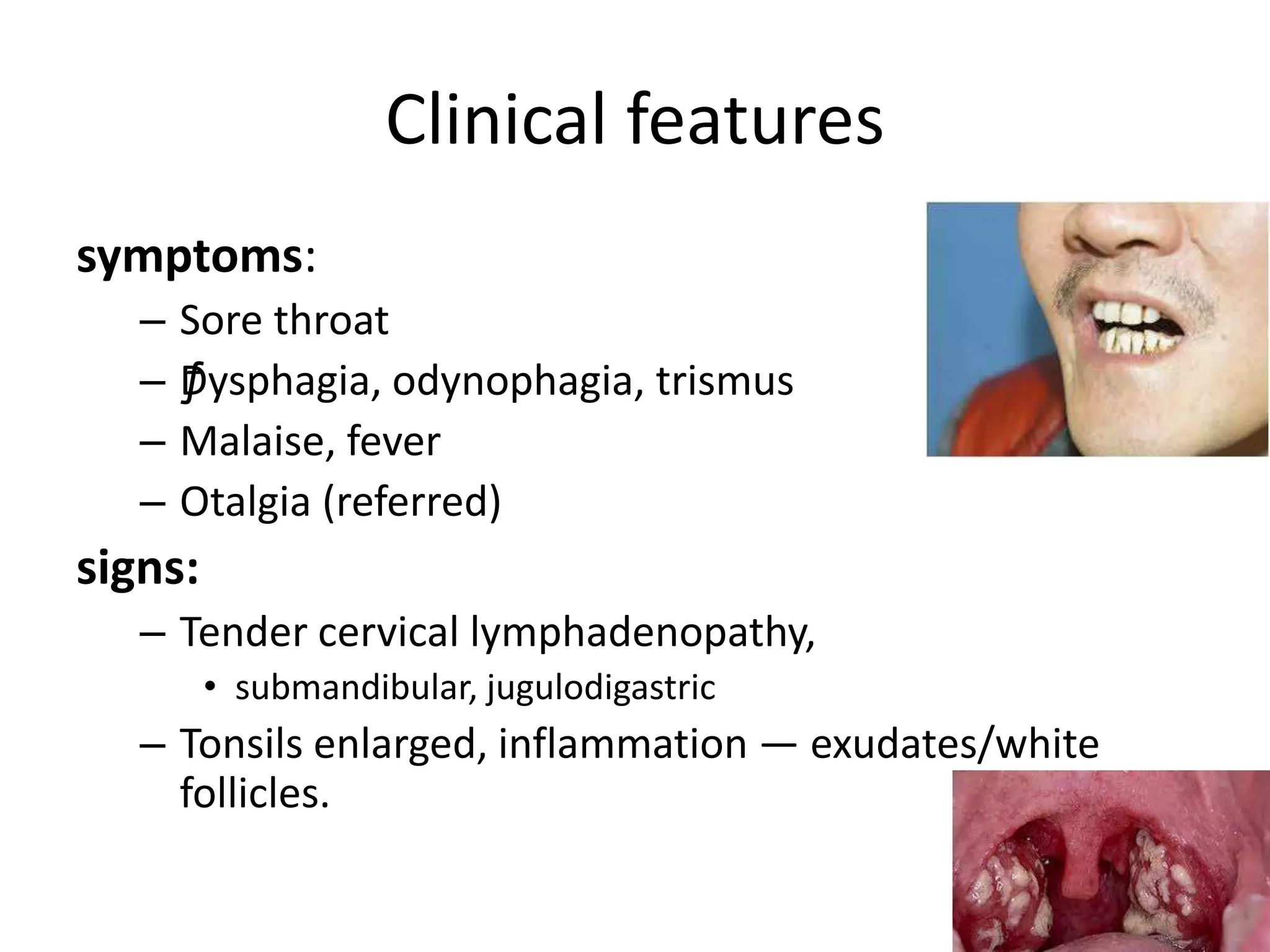approch to patient with Sore throat | PPTX