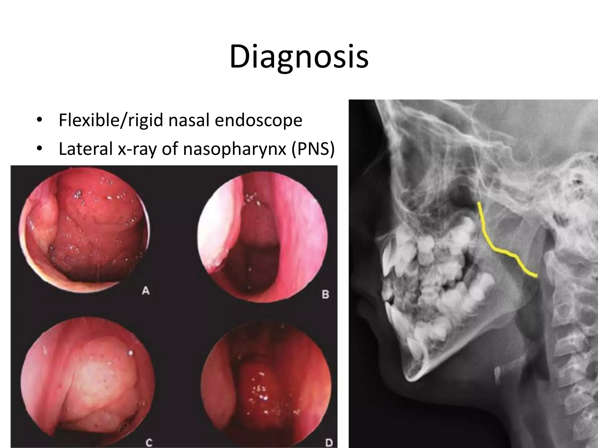 approch to patient with Sore throat | PPTX