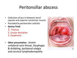 approch to patient with Sore throat | PPTX