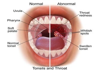 Normal Throat Vs Sore Throat