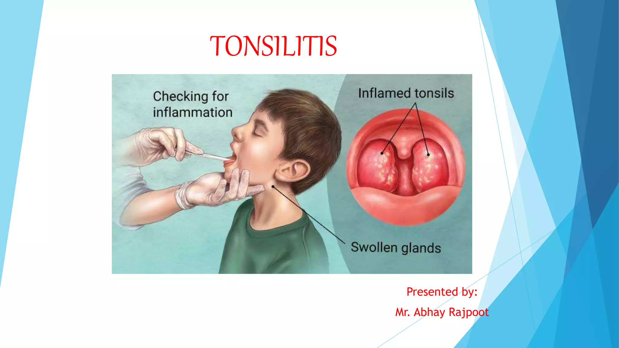 Tonsilitis | PPTX