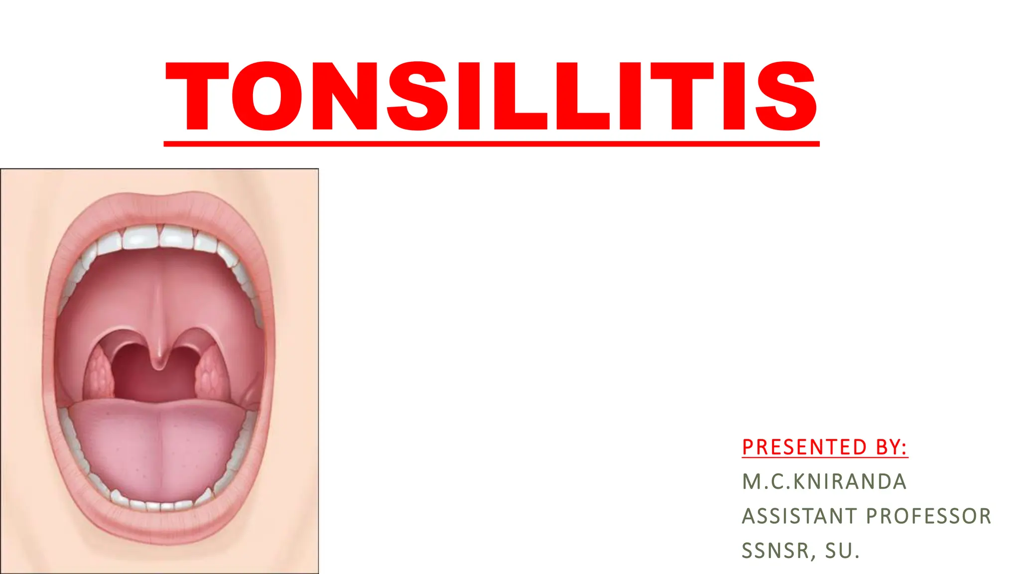 tonsilitis.pptx