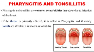tonsilitis.pptx