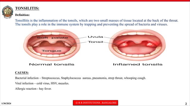 TONSILITIS AND ITS NURSING MANAGEMENT.pdf