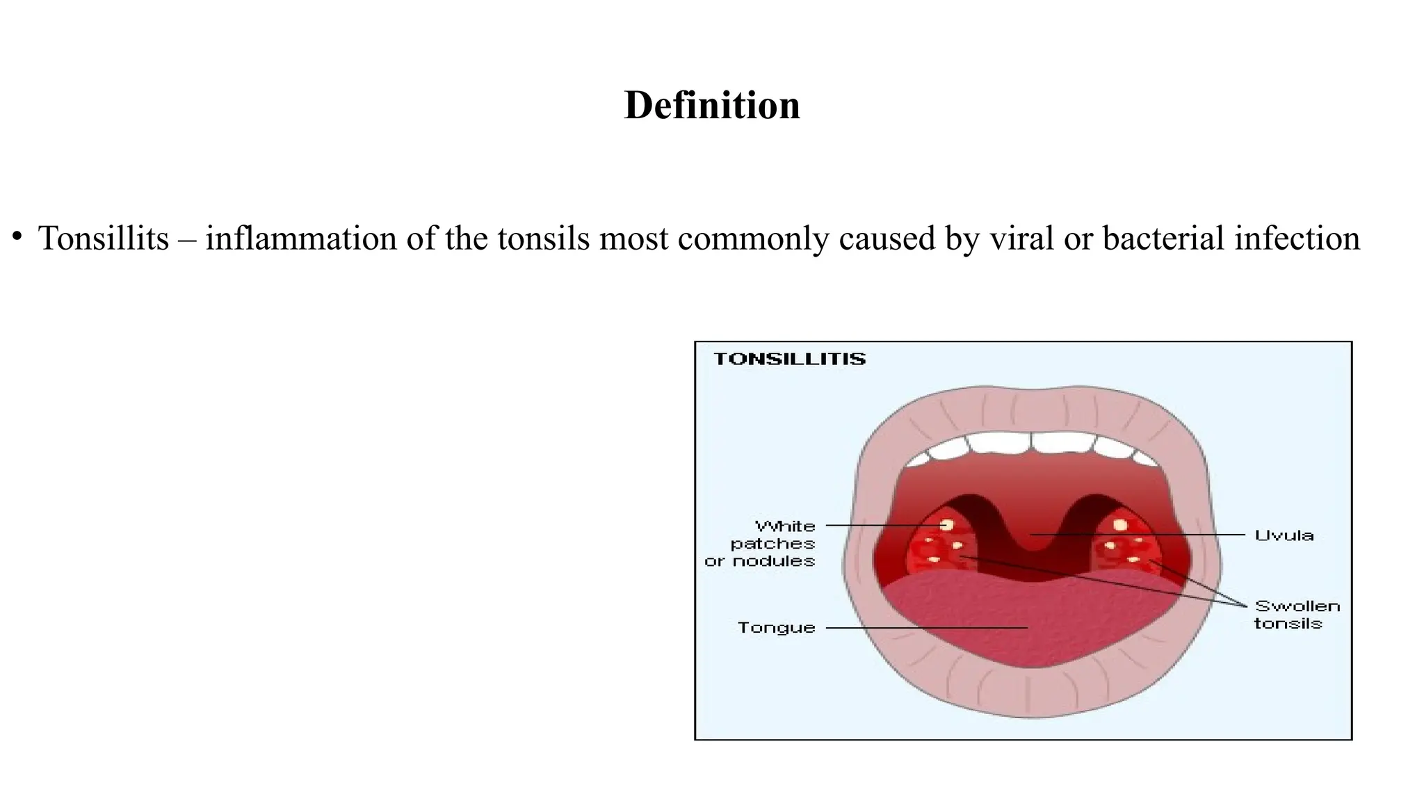 tonsilitis.pptx ENT EAR NOSE DISES MOUTHES | PPTX