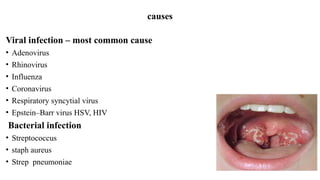 tonsilitis.pptx ENT EAR NOSE DISES MOUTHES | PPTX