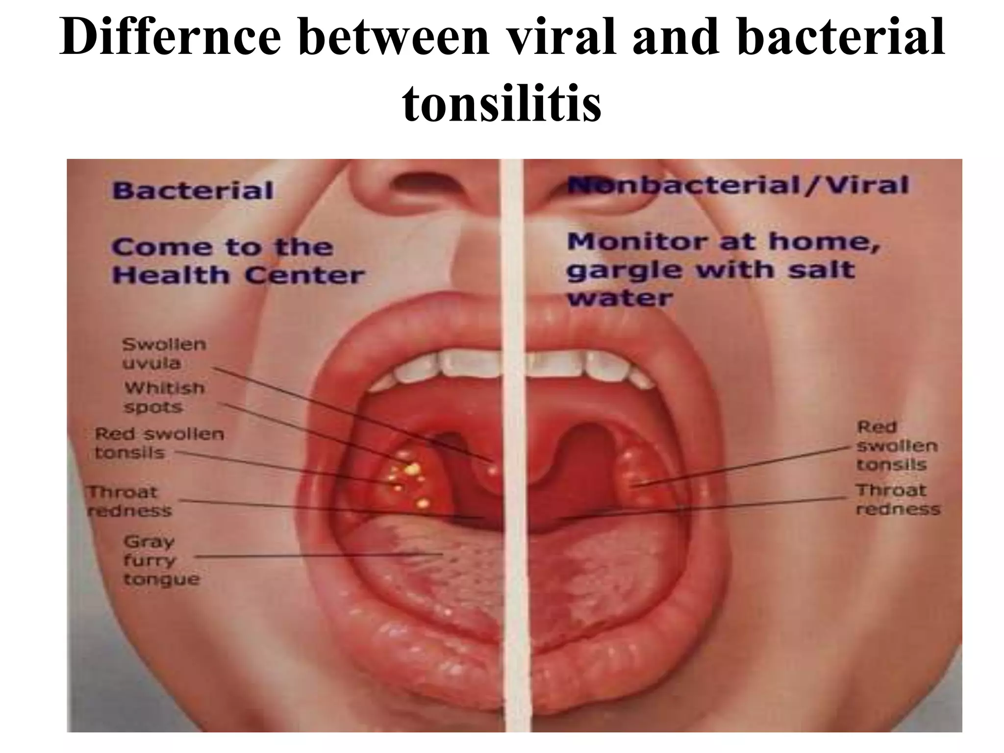 Tonsilitis (AHN) | PPTX