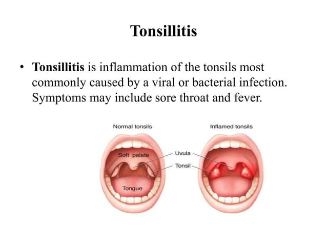 Tonsilitis (AHN) | PPTX | Ear, Nose and Throat Conditions | Diseases ...