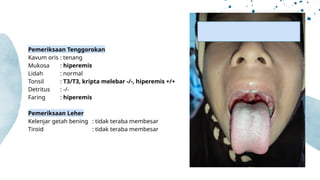 Penyakit Tonsilitis Akut dan Kronis.pptx