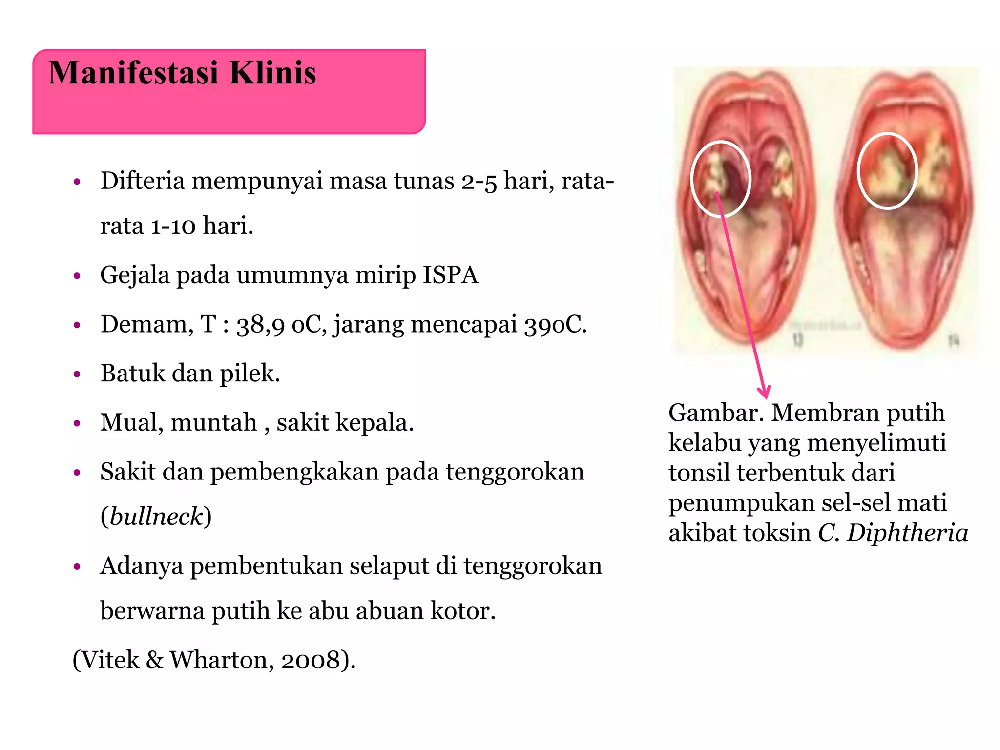 Tonsilitis Difteri_Vivi.pptx