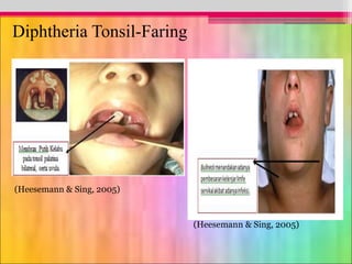 Tonsilitis Difteri_Vivi.pptx