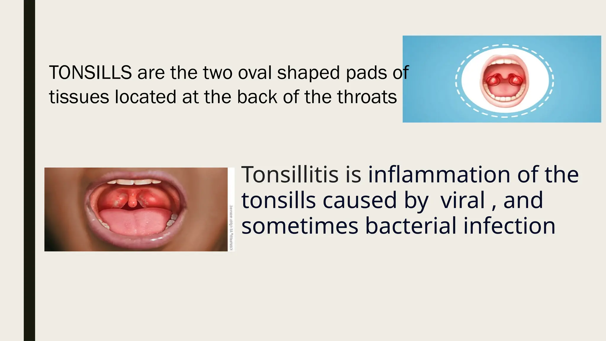 TONSILITIS Definition , types , causes , pathophysiology , riskfactors ...